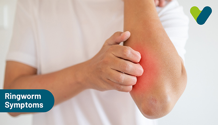 Ringworm Symptoms Discover The Signs And Symptoms Of Ringworm Disease